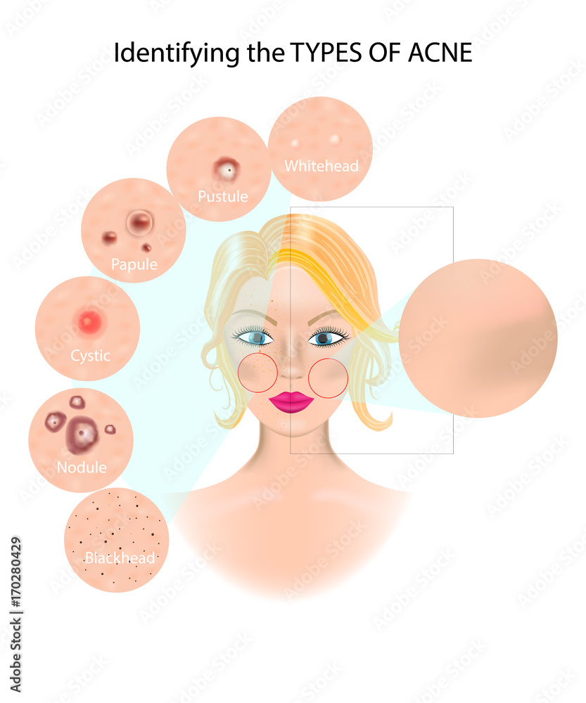 Identifying the TYPES OF ACNE. Stock Vector | Adobe Stock