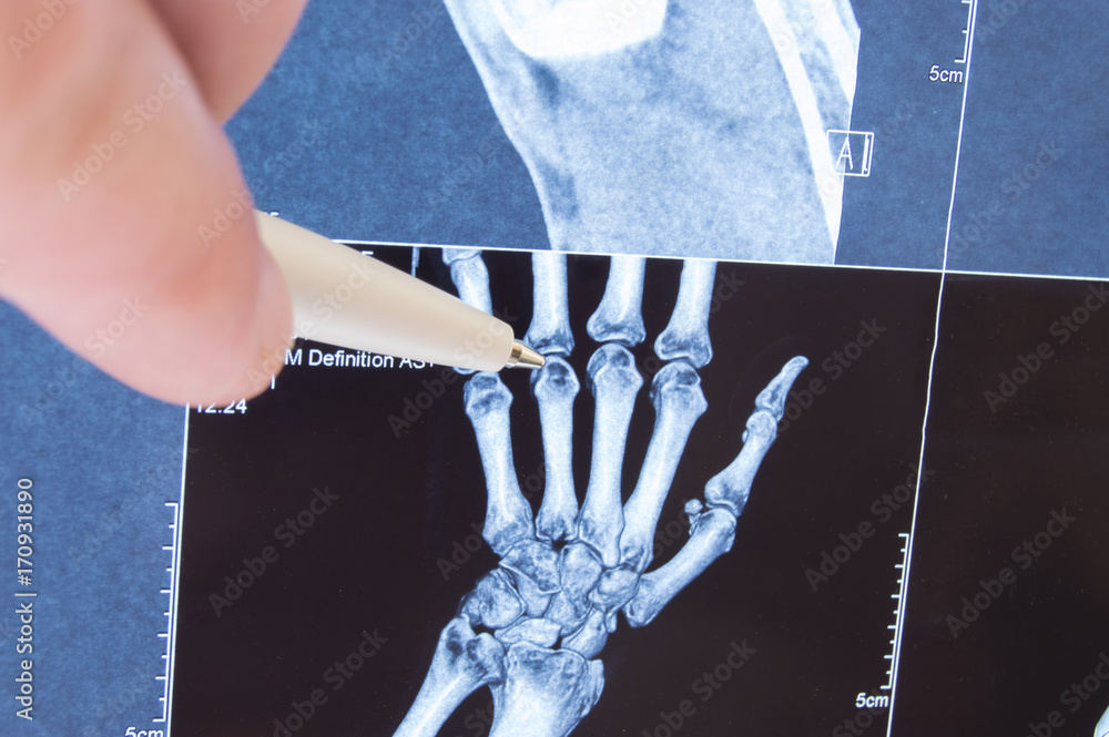 X-ray scan of hand, bones and finger joints. Doctor pointed on finger ...