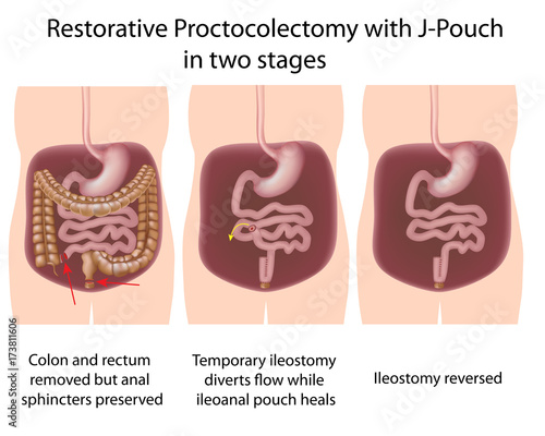 Restorative Proctocolectomy With J Pouch In Two Stages Stock Illustration Adobe Stock