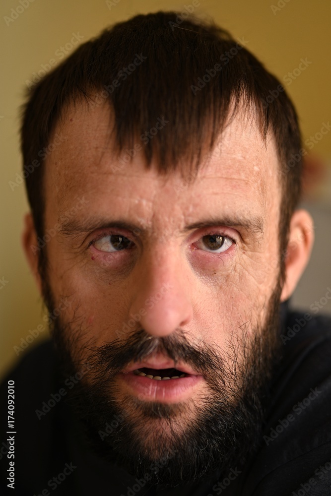 Photo Stock homme trisomique | Adobe Stock