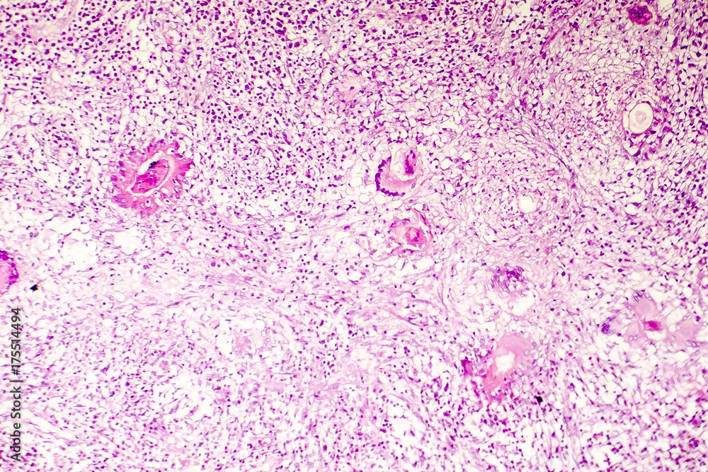 Стоковое фото «Liquefactive necrosis of the human brain, light ...