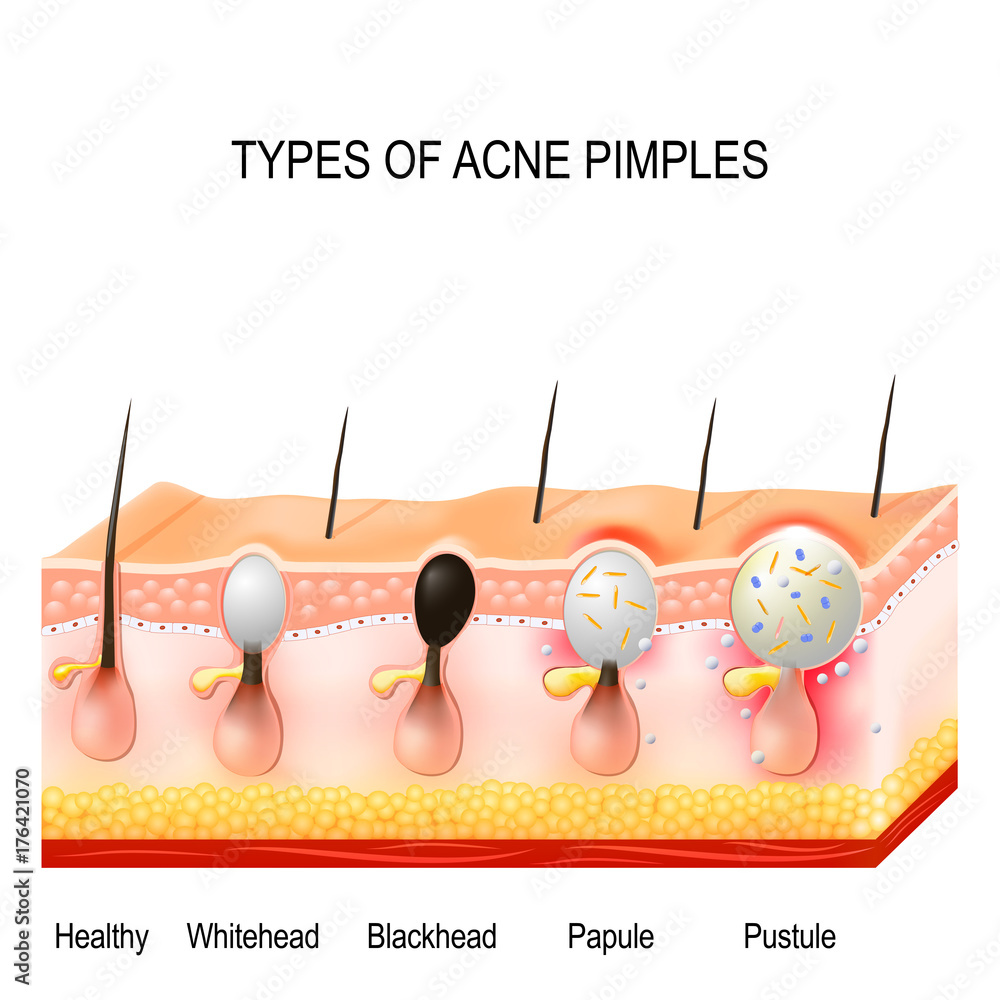Types of acne pimples Stock Vector | Adobe Stock