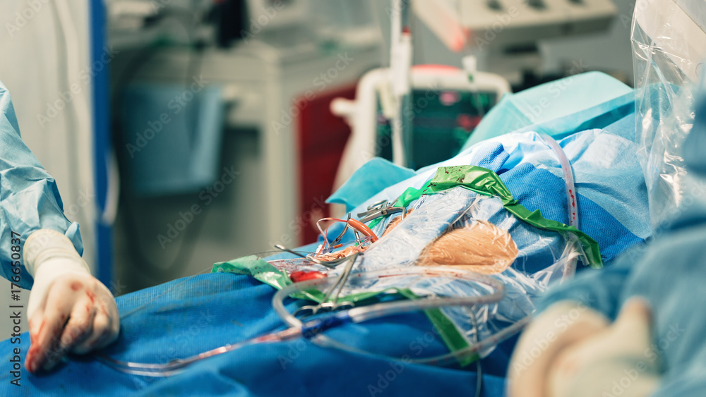 Interventional cardiologist surgeon do AAA endovascular treatment stent ...