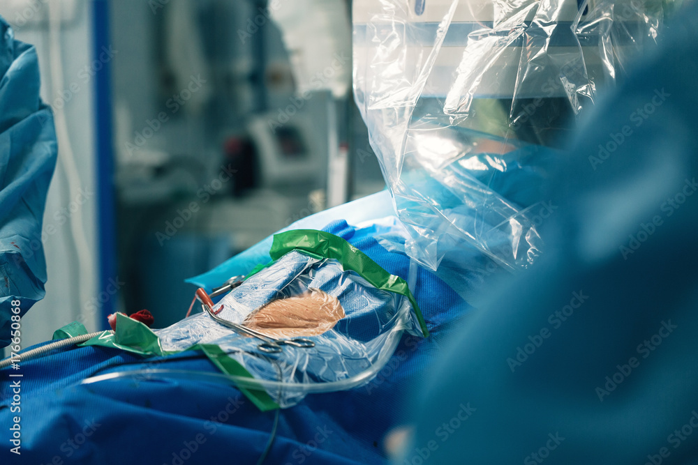 Interventional cardiologist surgeon do AAA endovascular treatment stent ...