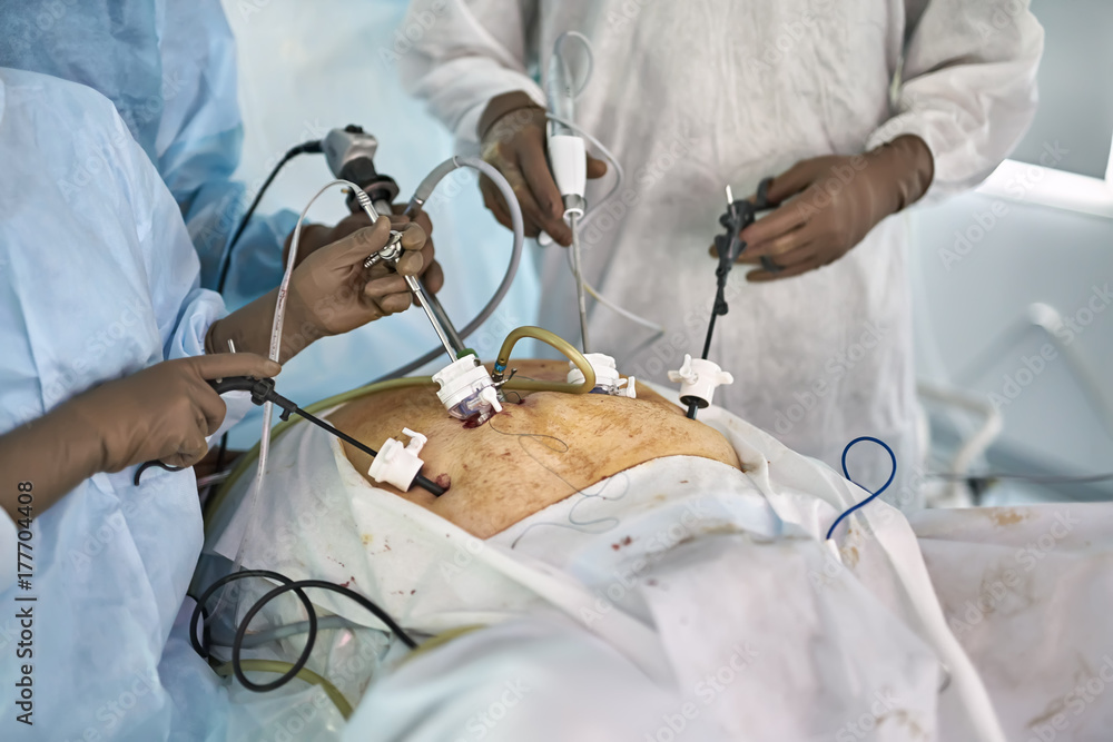 Laparoscopy operation process Stock Photo | Adobe Stock