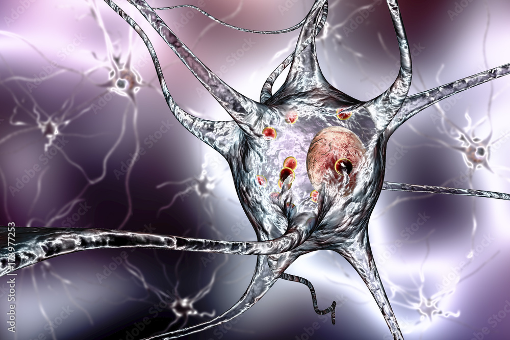 Ilustração Parkinson's disease. 3D illustration showing neurons ...