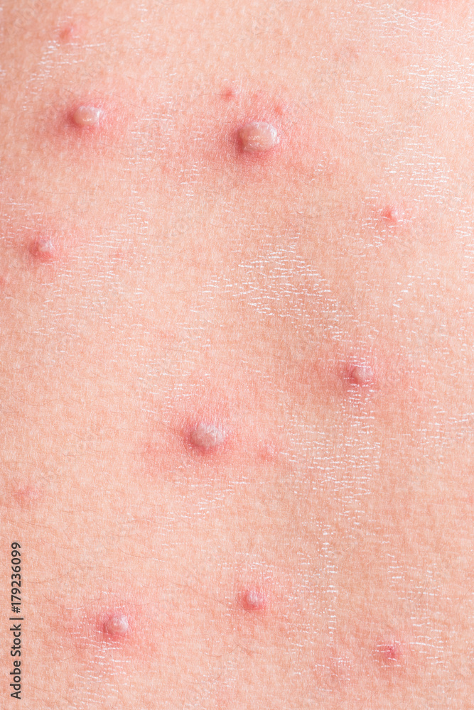 Chicken pox rash Stock Photo | Adobe Stock