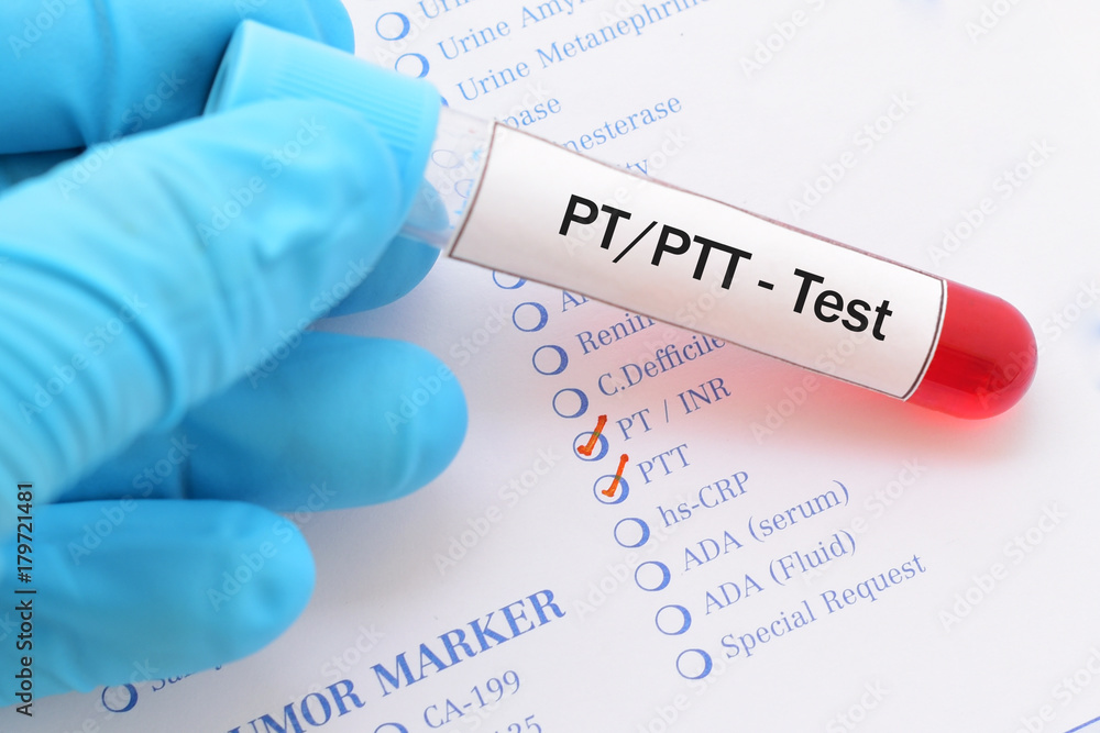 Blood sample with requisition form for PT and PTT test, diagnosis for ...
