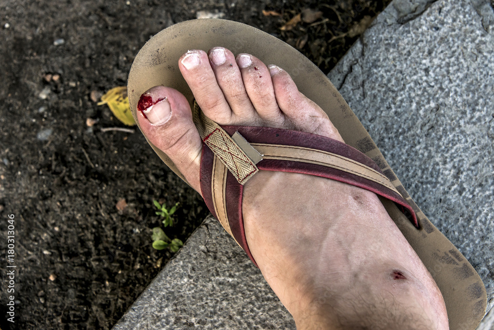 Accident flip flop cut foot nail toe have a bloody and bleeding wound ...