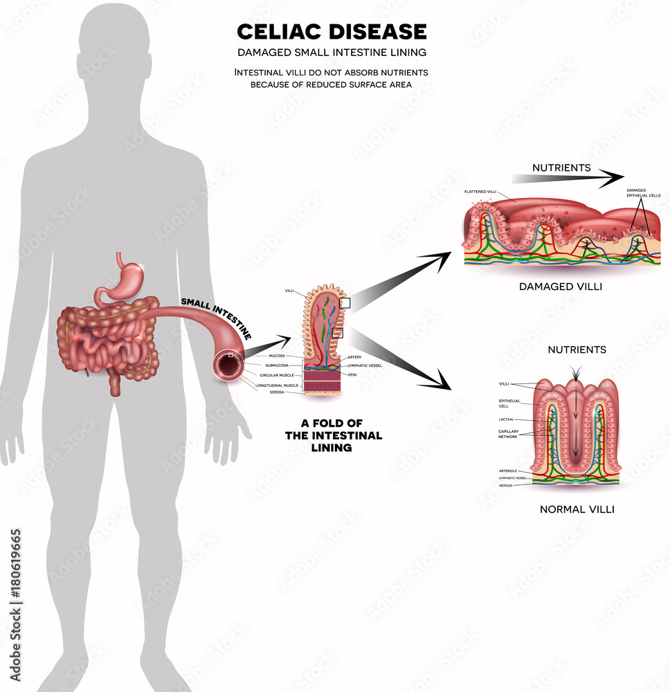 Celiac disease- Damaged cells by body's reaction to gluten. Intestinal ...