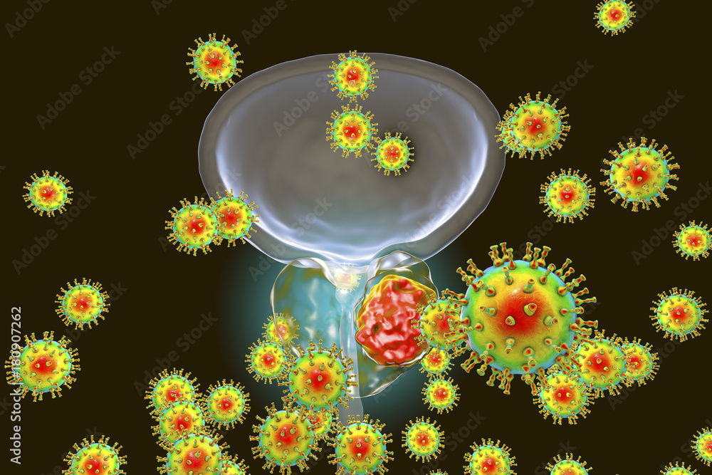 Conceptual image for viral ethiology of prostate cancer. 3D ...