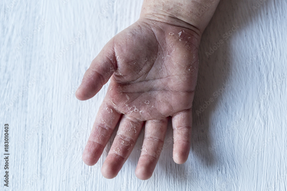 scarlet fever rash on hands and feet