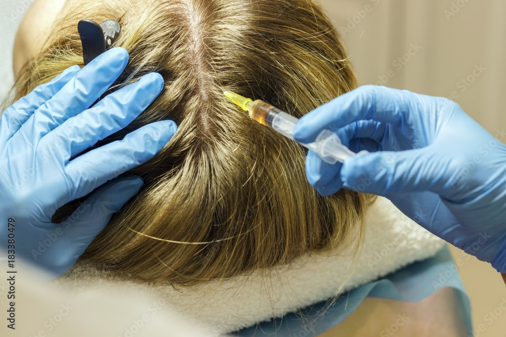 The procedure for treating hair from falling out by injection. The ...