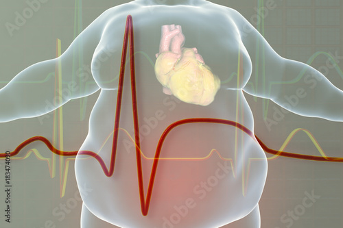Heart disease in a person with obesity, conceptual image. 3D ...