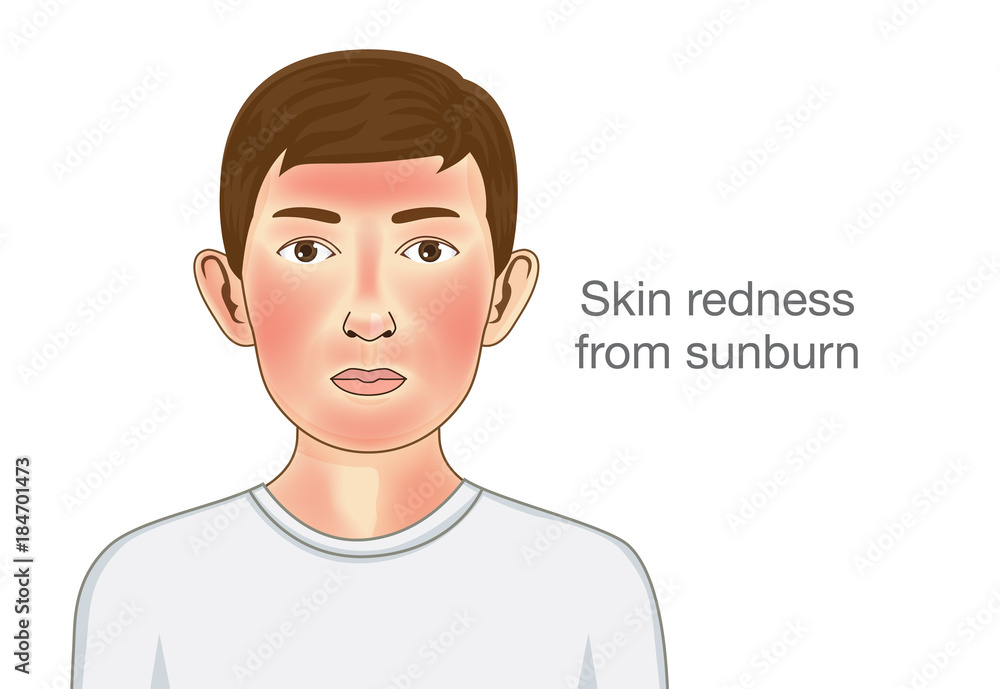 Skin redness appear on facial and neck of kid from sunburn ...