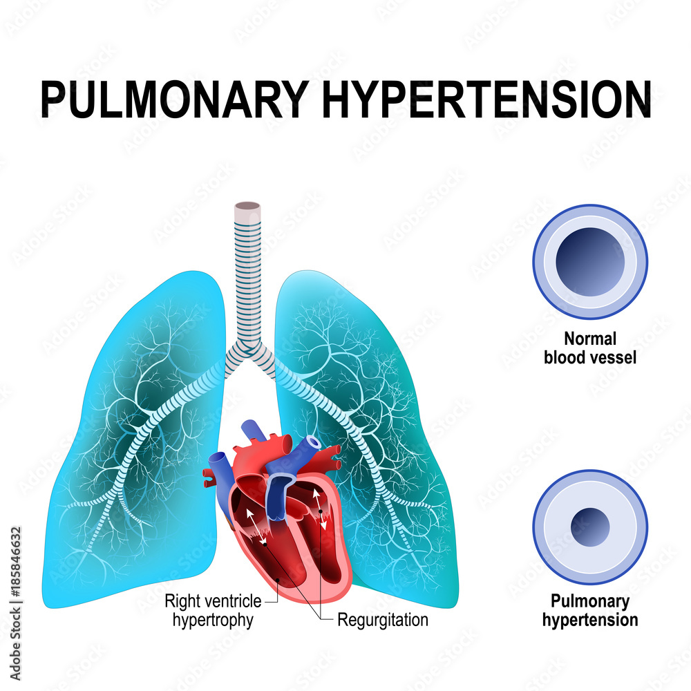 Pulmonary hypertension Stock Vector | Adobe Stock
