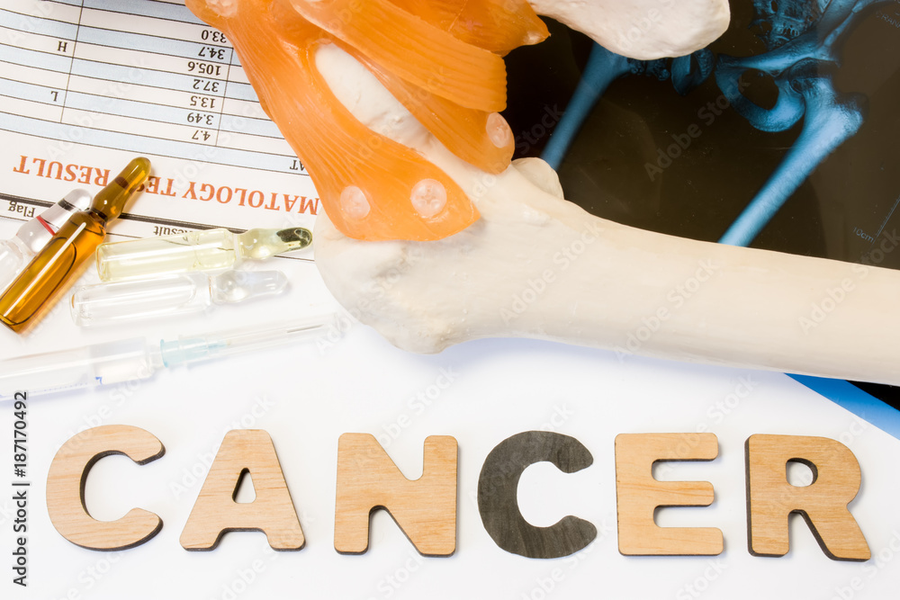 Bone cancer concept. Anatomical shape of femur bone and joint lies near ...