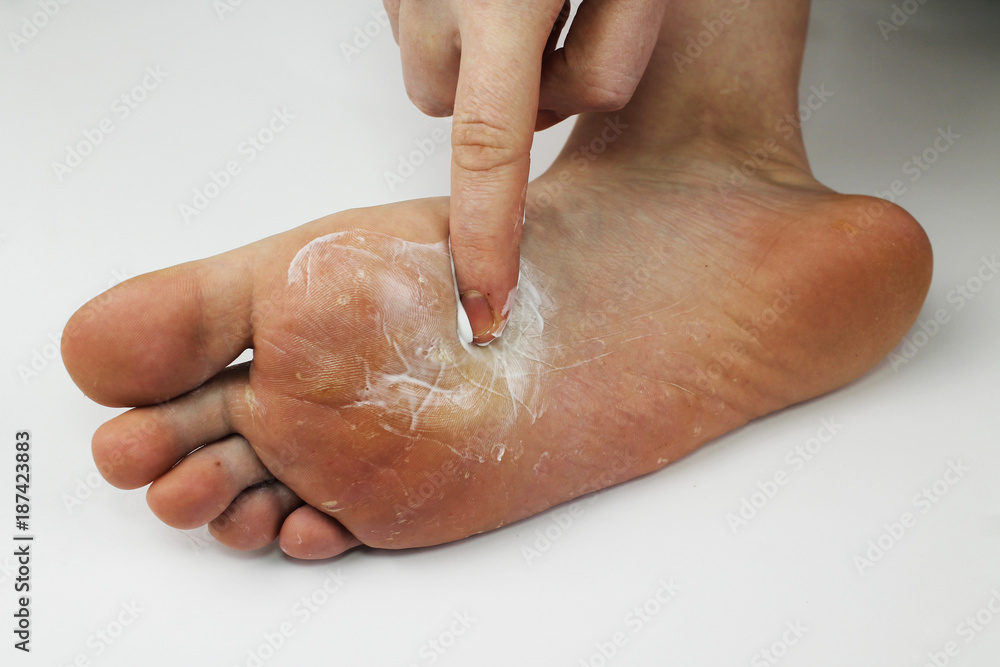 Fungus of foot close-up, isolated on white background. The concept ...