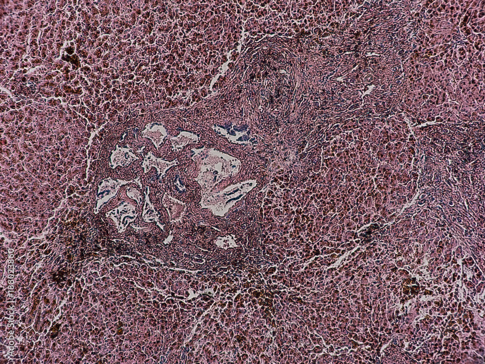 Human Pathology - Pigmentary cirrhosis of liver - Abnormal alterations ...