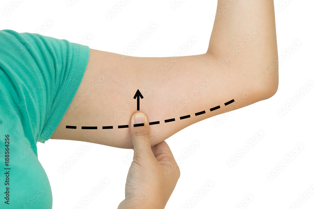 Closed up of woman grabbing skin on upper arm with the drawing arrows ...