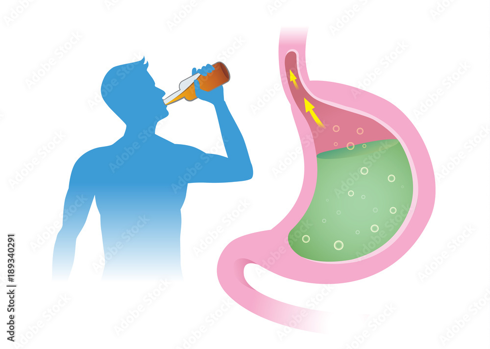 People have acid reflex in stomach from drink alcohol. Illustration ...