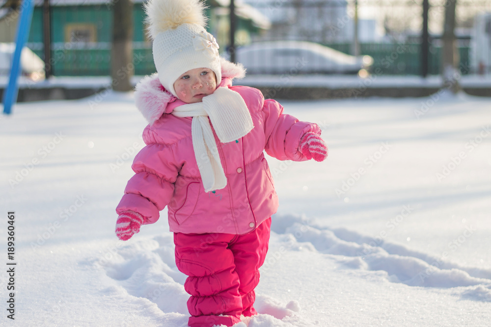 beautiful baby girl with frostbitten face or with allergic rash on ...