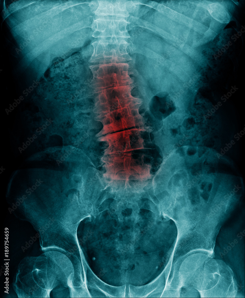 scoliosis lumbar with loss space of disc, herniated disc and lumbar ...
