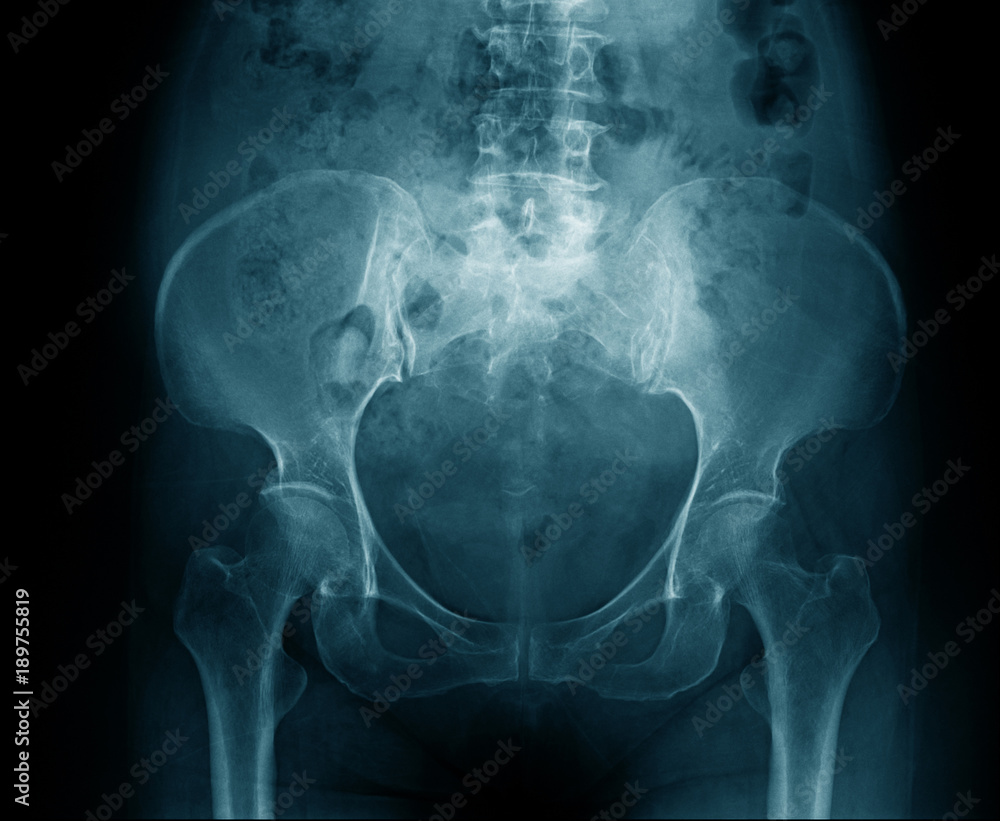 x-ray lower back with pelvic bone show lumbar spondylosis and scoliosis ...