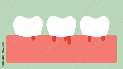 gingivitis or gum disease with bleeding, gum inflammation before ...