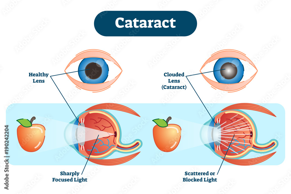 Cataract vector illustration diagram, anatomical scheme. Stock Vector ...