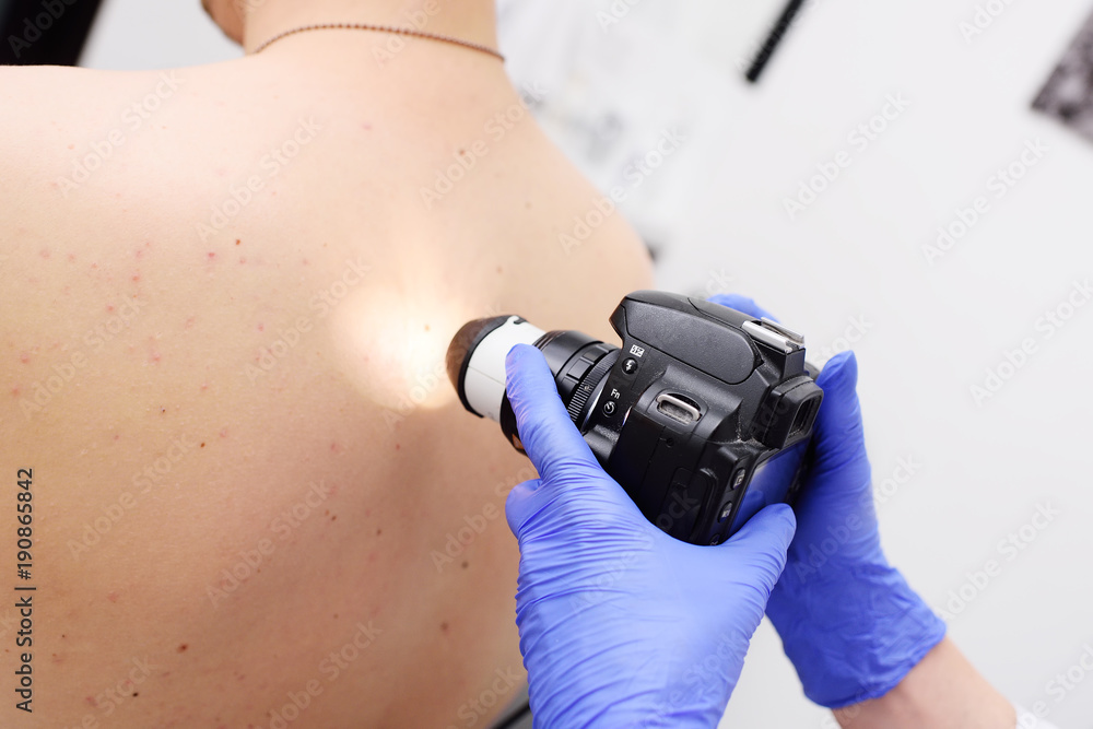 Method of dermatoscopy of skin lesions and moles. Preventing Melanoma ...