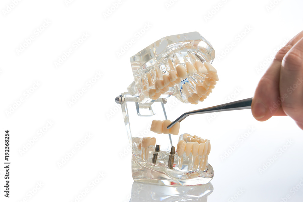 Dental technician placing the fixed partial denture, dental bridge on ...