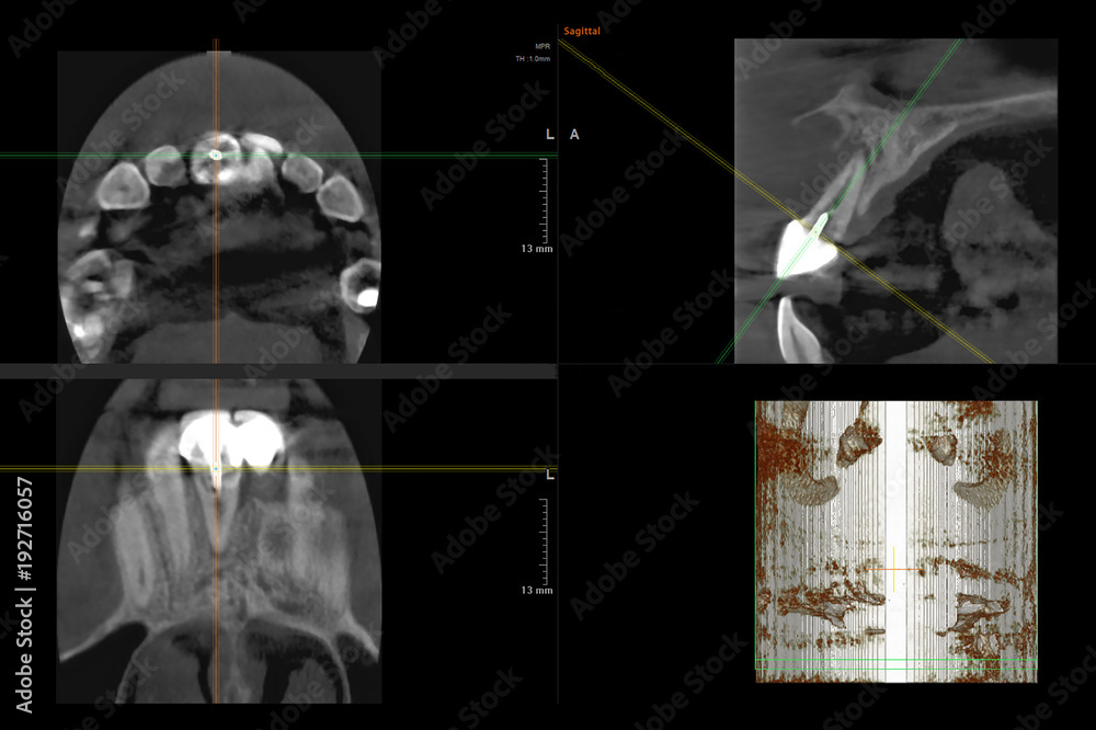 Dental 3D X-Ray of teeth Stock Photo | Adobe Stock
