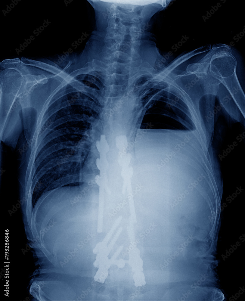 Zdjęcie bez tantiem: fixation of thoracic-lubar spine, x-ray image show ...