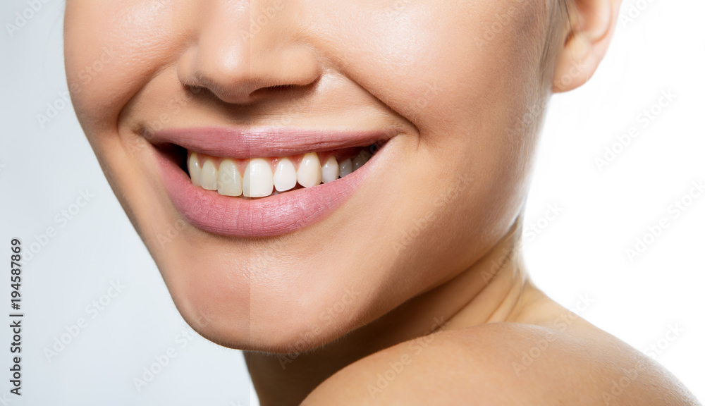 Teeth befor and after care, therapy and whitening. Laughing woman mouth ...