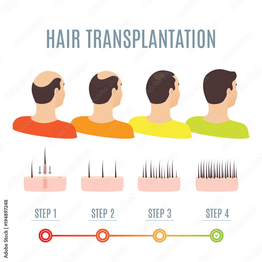 Hair transplantation surgery steps infographics. Man patient before and ...