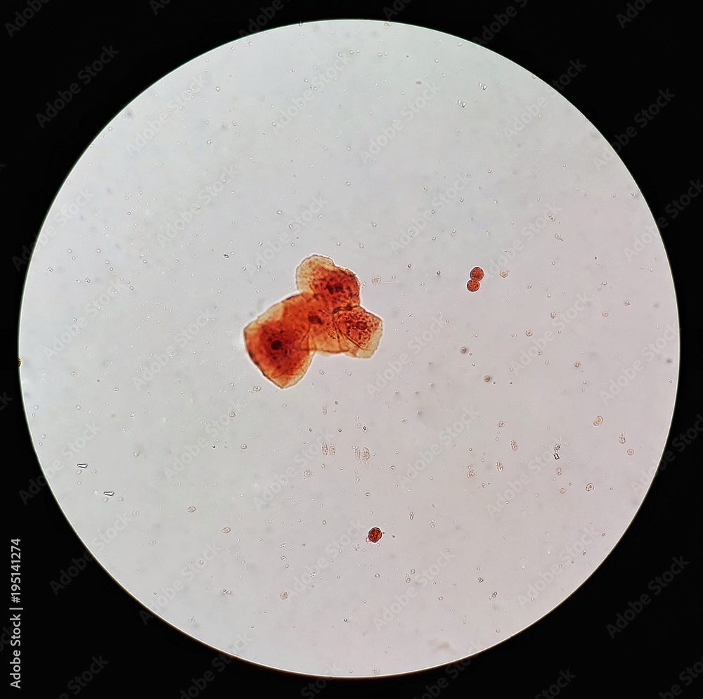 Urine microscopic examination with iodine stained present squamous ...