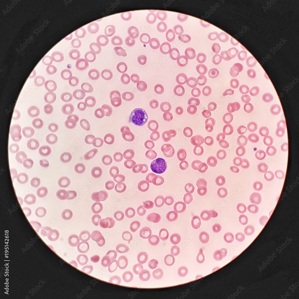 Human blood smear under 100X light microscope with blast cells and ...