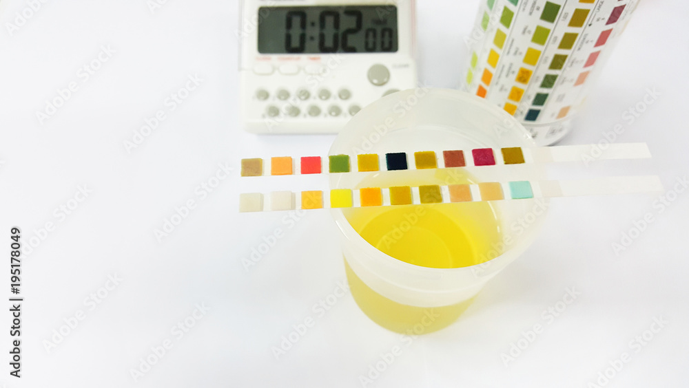 A urine strip test used to determine in urine sample . The test read ...