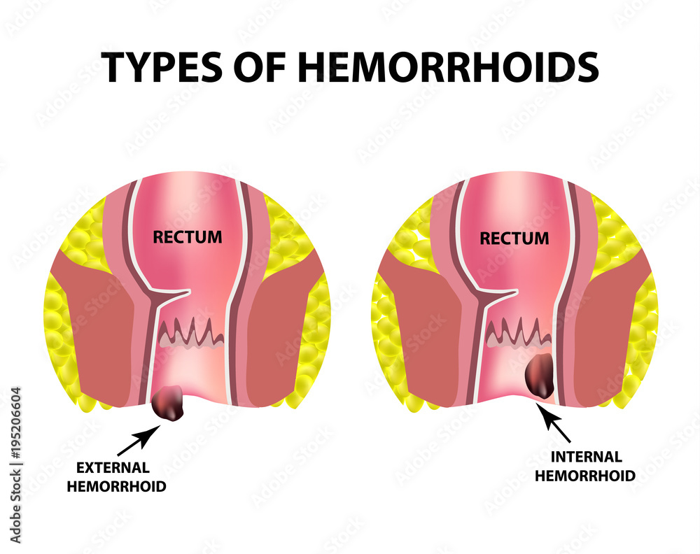 Vettoriale stock di Two types of hemorrhoids are external and internal ...