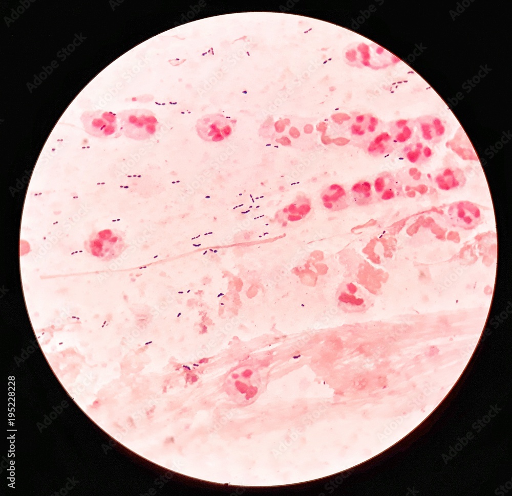 Stock-Foto „Smear of Gram's stained from sputum specimen with gram ...