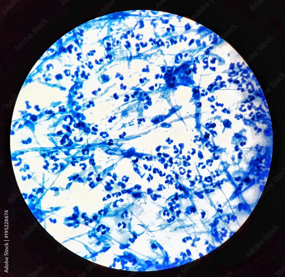 ภาพถ่าย Stock Smear of Acid-Fast bacilli (AFB) stained from sputum ...