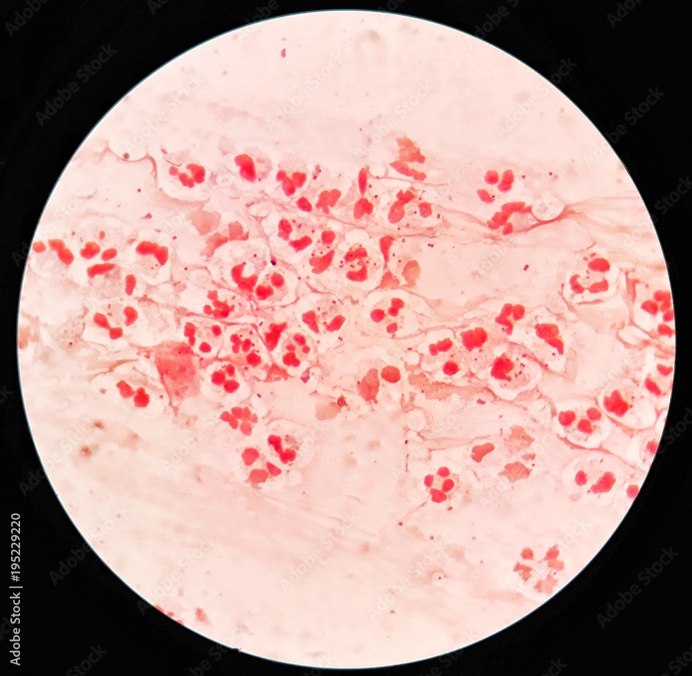 Smear of sputum specimen with gram negative cocci bacteria and many ...