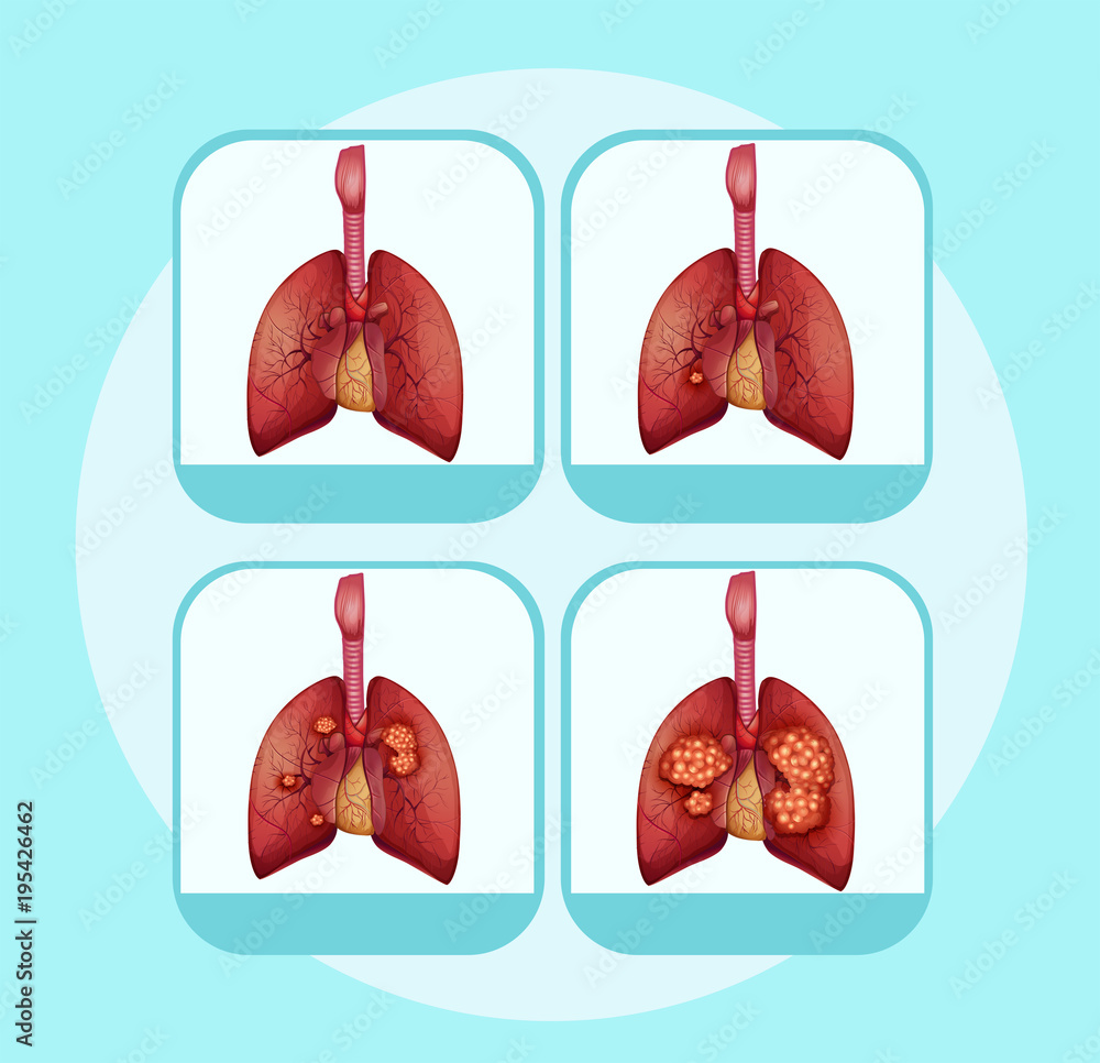 Diagram Showing Different Stages Of Lung Cancer Stock Vector Adobe Stock