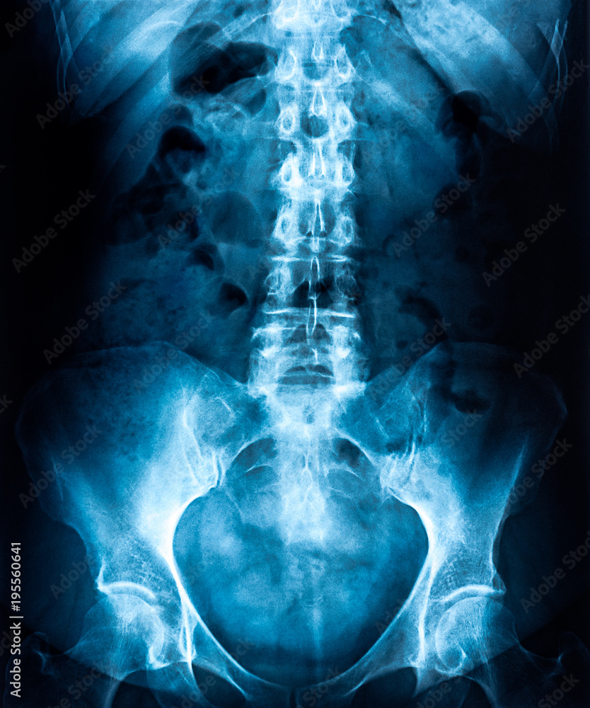 Lumbar Spine X-ray, Lower Back Stock Photo | Adobe Stock