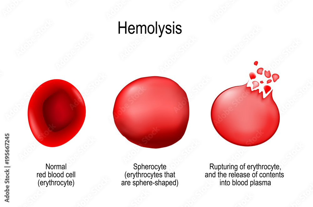 Hemolysis. Normal red blood cell, spherocyte, and rupturing of ...