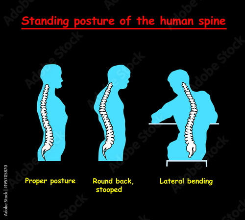Standing posture of the blue human spine. Defects of the human spine ...