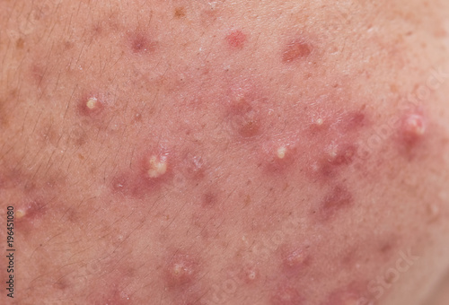 The Best Ways To Get Rid Of Scabies? - What Is Middle Ear Infection?