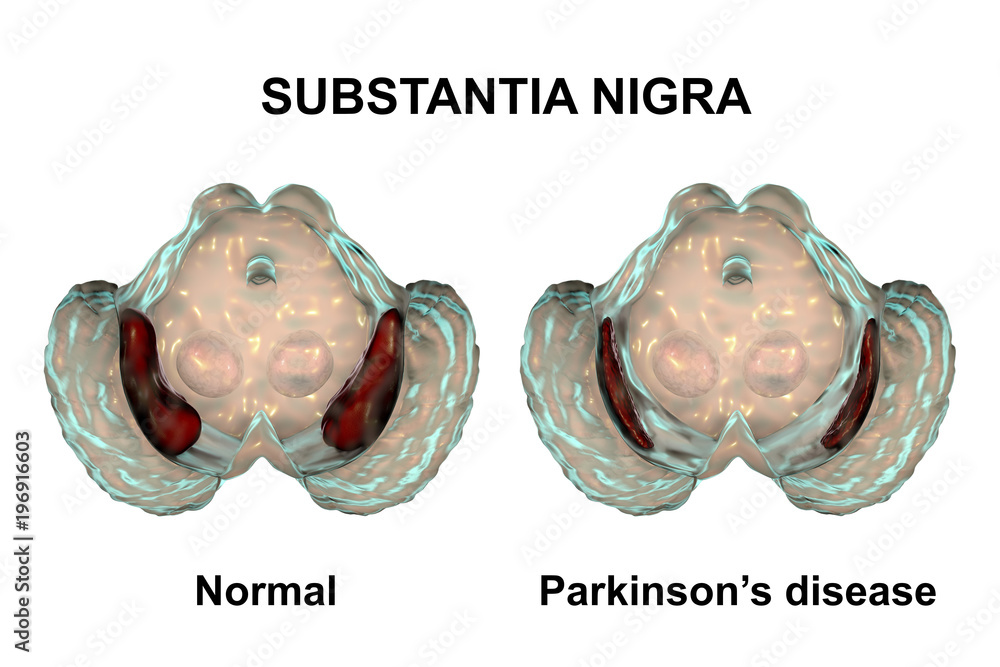 Stock-Illustration „Substantia nigra in norm and in Parkinson's disease ...