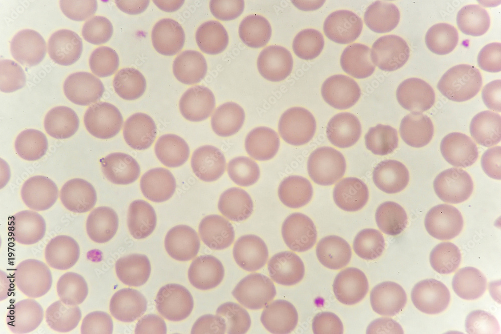 Red blood cells and platelet in blood smear, analyze by microscope ...
